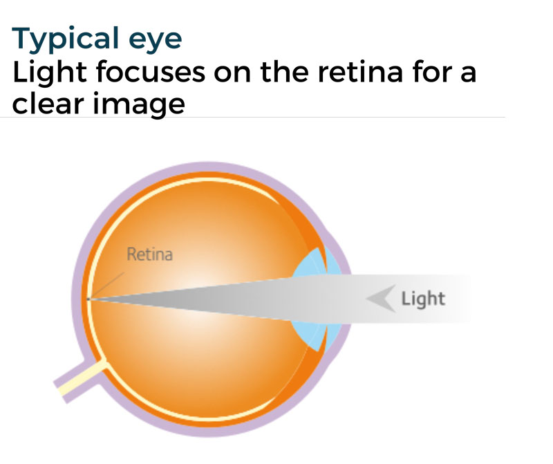 Myopia Management | J.S. Lowry Eyecare